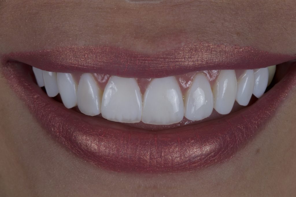Indirect Veneers | Johnny Mercado Dental Design Center